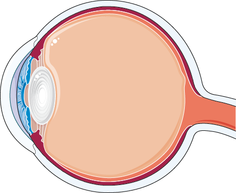 Cataract - Cataract Surgery - (470x385) Png Clipart Download