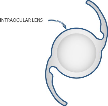 Cataract Lenses Iol Icon - Cataract - (375x370) Png Clipart Download