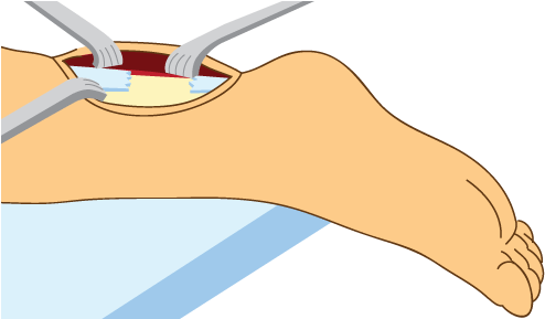 Achilles Tendon - (504x288) Png Clipart Download