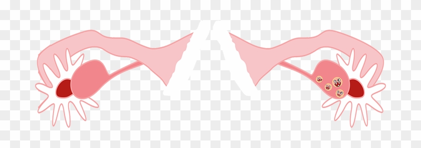 Medical Treatment Pcos - Polycystic Ovary Syndrome - Full Size PNG ...