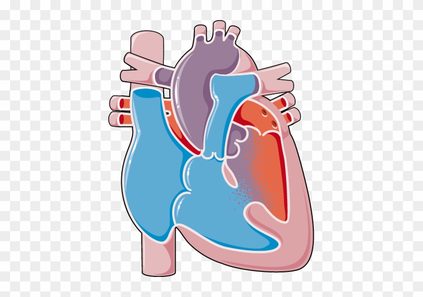Congenital Heart Disease - Ventricular Septal Defect - Full Size PNG ...
