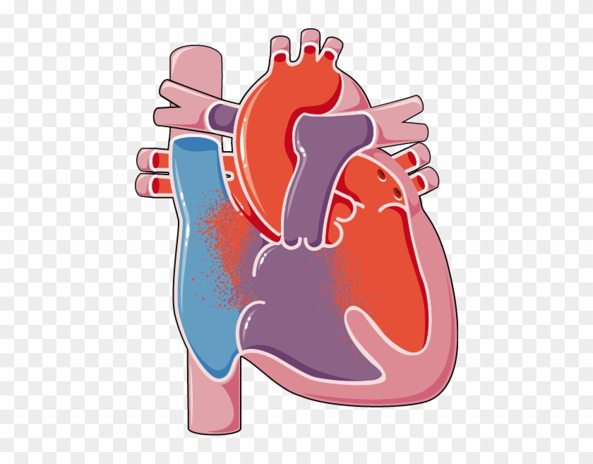 Congenital Heart Disease Atrioventricular Canal Defect - Ventricular ...