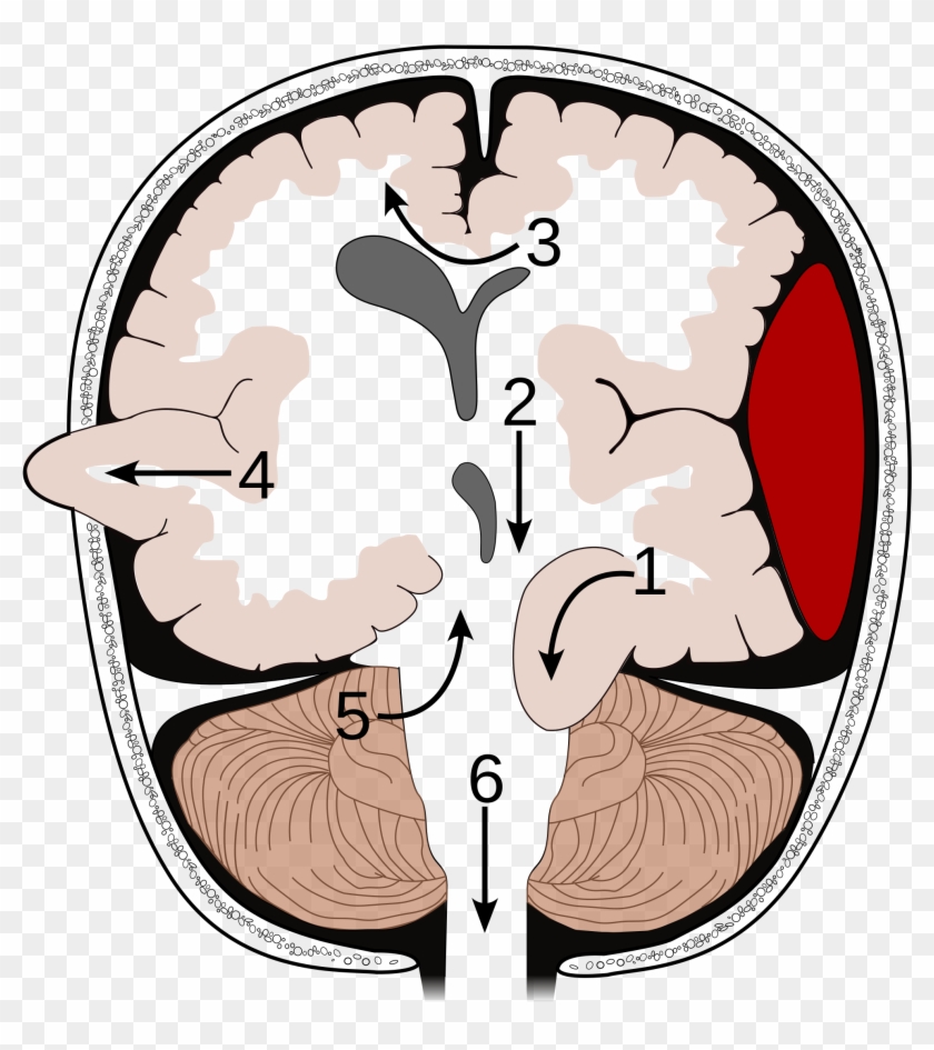 Brain - Types Of Brain Herniation - Full Size PNG Clipart Images Download