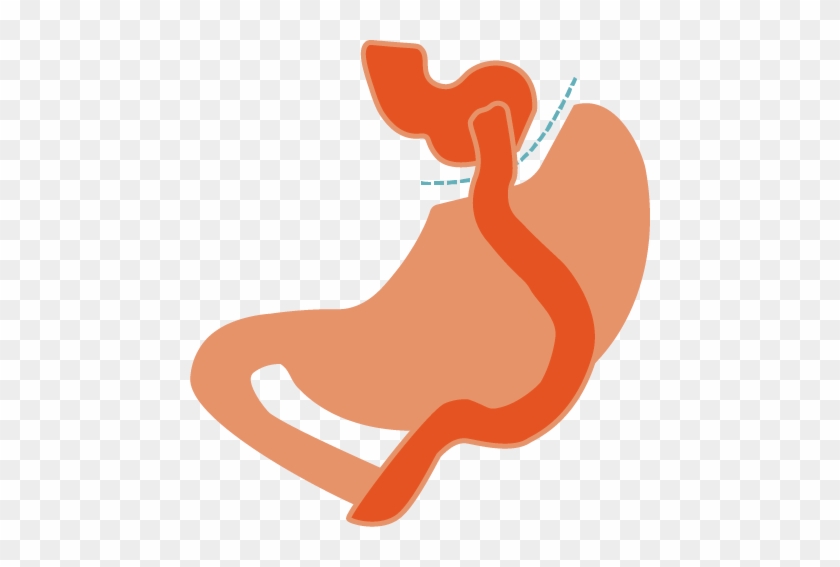 Laparoscopic Bypass Surgery - Illustration - Full Size PNG Clipart ...