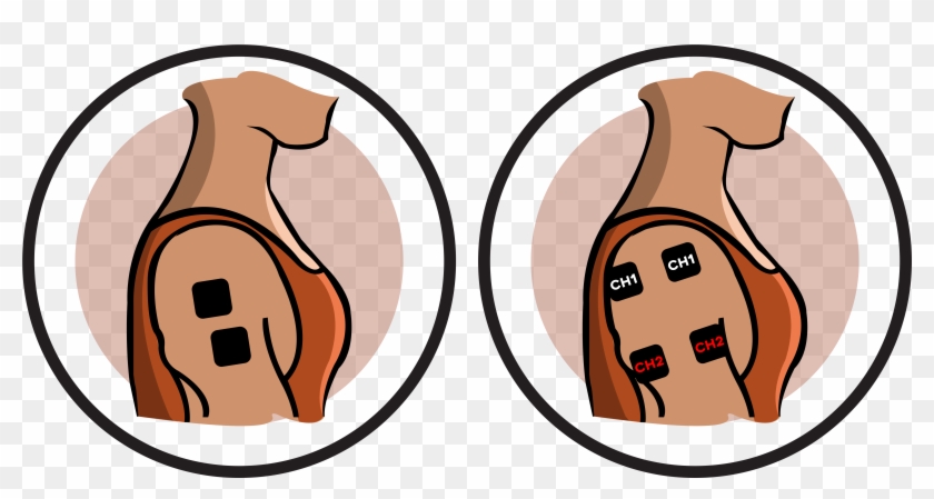 Shoulder Electrode Pad Placement - Transcutaneous Electrical Nerve ...