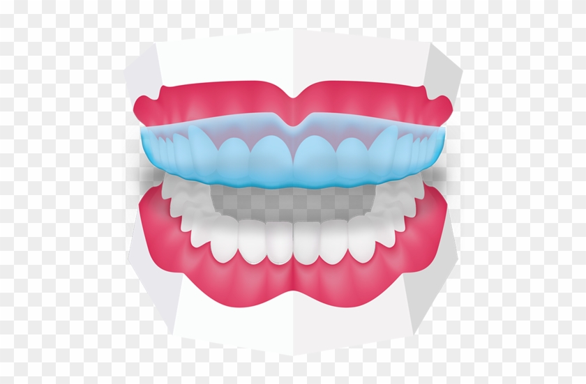 Mouthguards At Toothbeary - Orthodontics - Full Size PNG Clipart Images ...