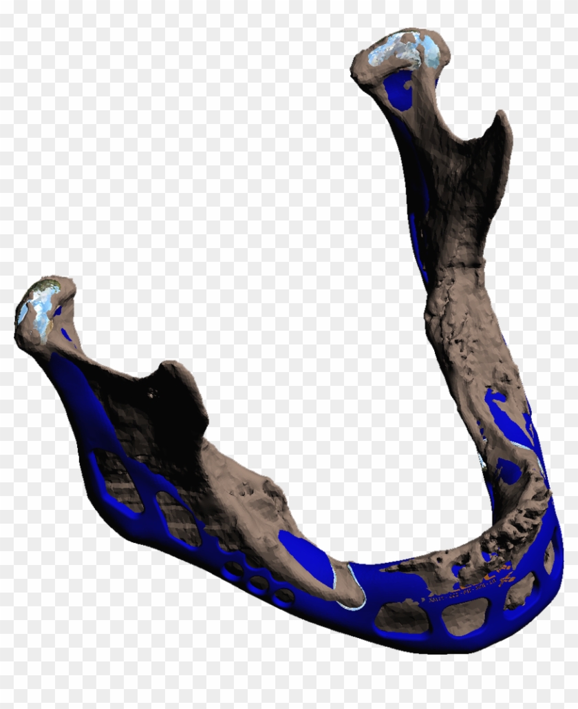 Psi Design - Full Jaw Implant - Full Size PNG Clipart Images Download