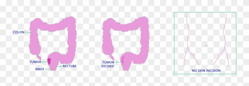 Local Excision Diagram For Tamis Surgery - Illustration - Full Size PNG ...