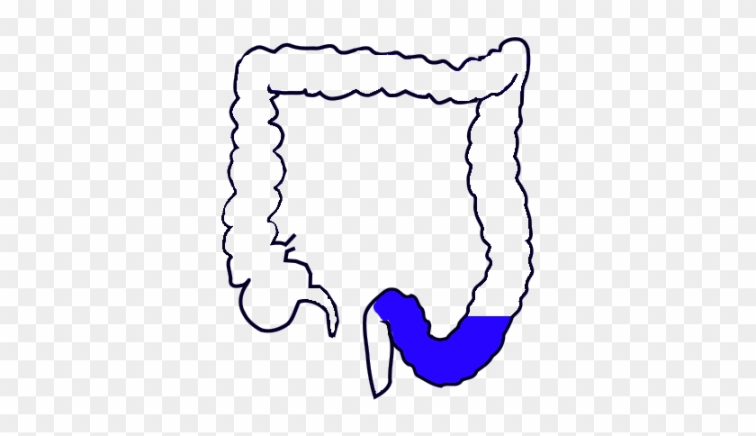 Sigmoid Colon - Sigmoid Colon - Full Size PNG Clipart Images Download