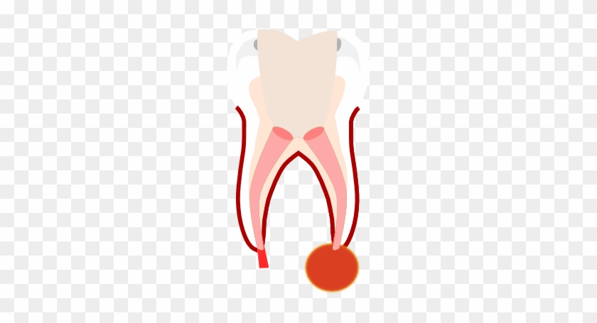 Preparation Of The Root Canals - Illustration - Full Size PNG Clipart ...