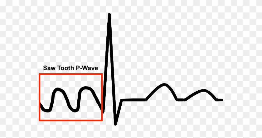 Atrial Flutter - Atrial Flutter - Free Transparent PNG Clipart Images ...