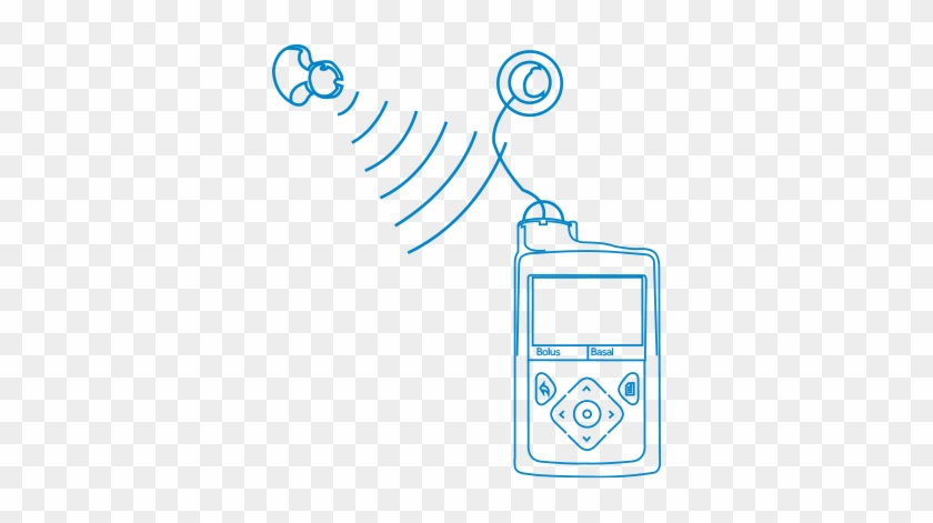 How Does Continuous Glucose Monitoring Work - How Does Continuous ... How Does Continuous Glucose Monitoring Work - How Does Continuous ...