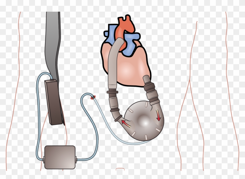 Ventricular Assist Device - Full Size PNG Clipart Images Download