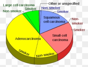 Pie Chart Showing Incidence Of Adenocarcinoma Of The - Most Common Lung ...