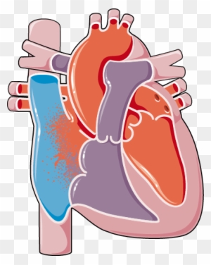 Congenital Heart Diseases Atrial Septal Defect - Ventricular Septal ...