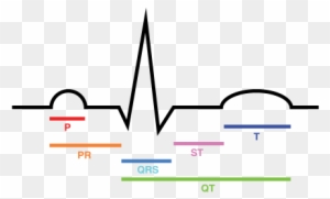 File - Ecg Intervals - Svg - Sa Node Damage On Ecg - Full Size PNG ...